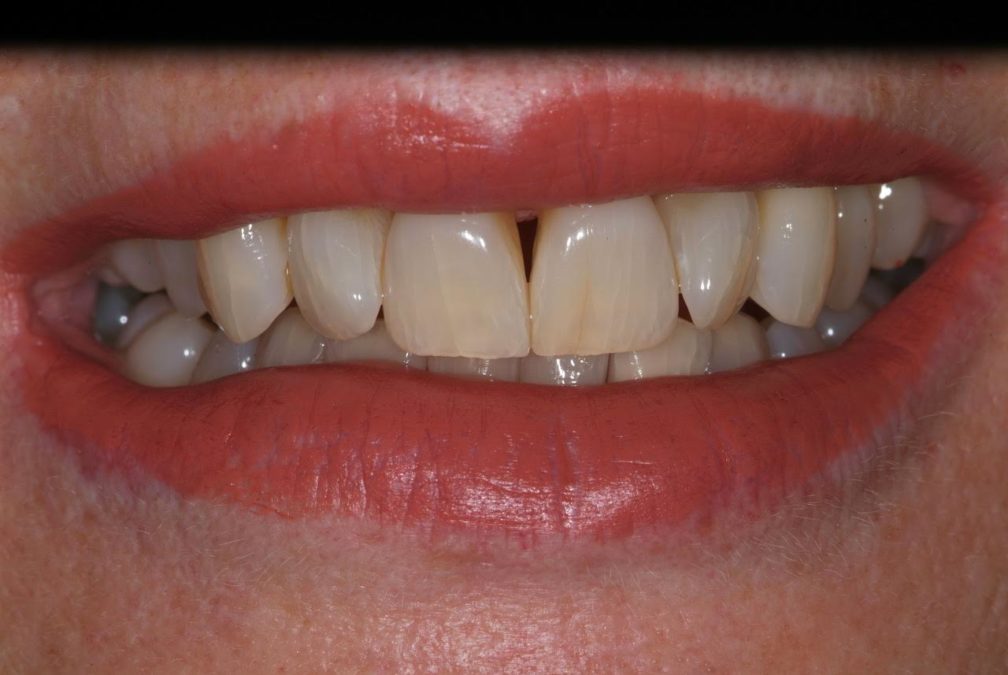 Teeth Bleaching - Dentist Remuera - The Oral Care Company